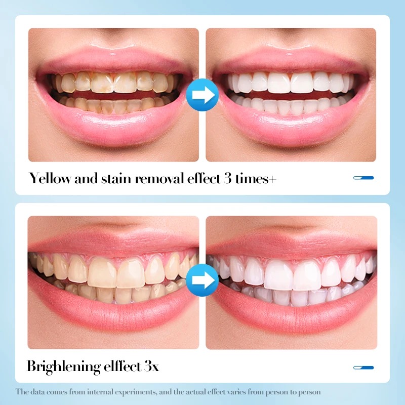 Professional Teeth whitener – Fizuro